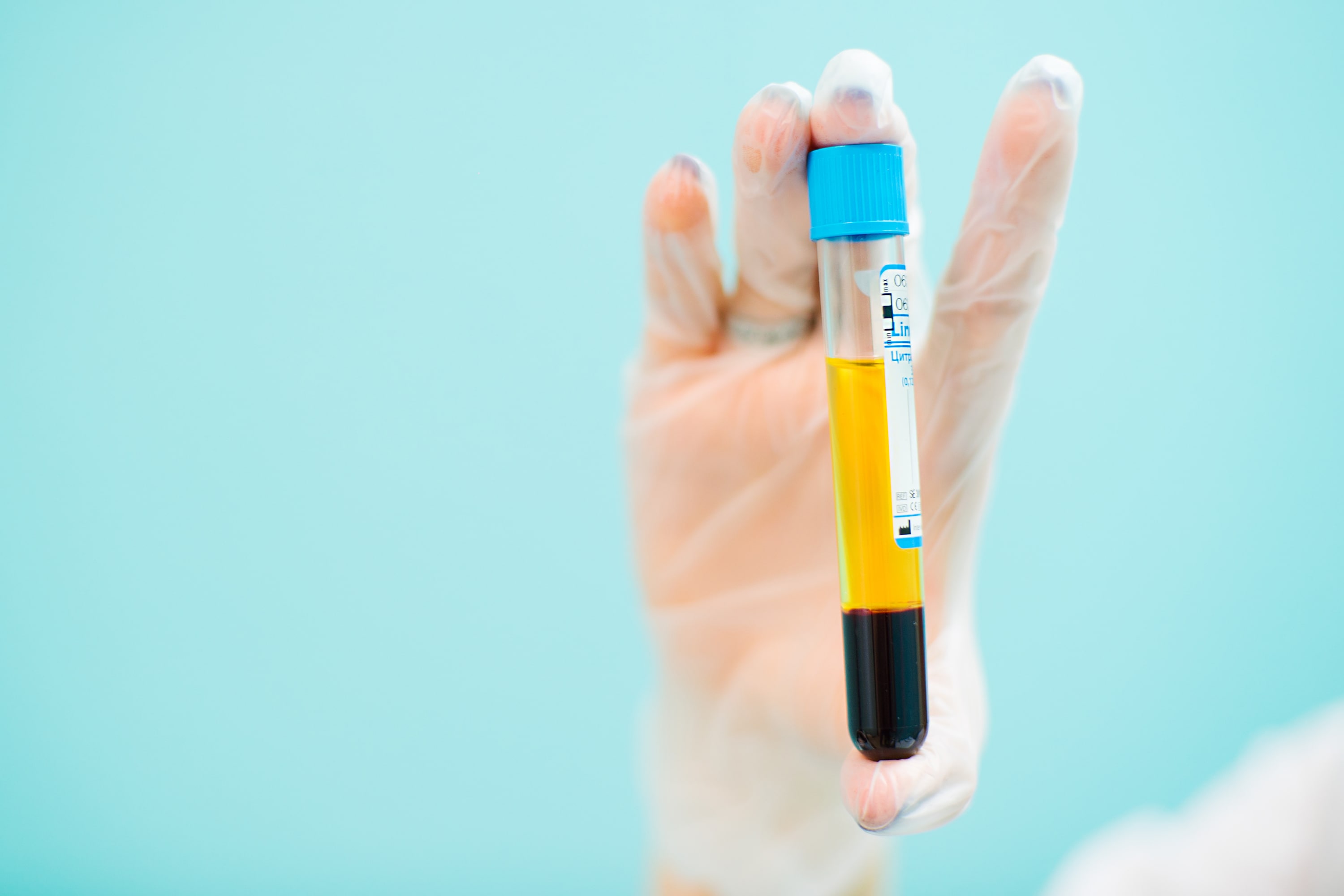 Improving the Detection of Thyroglobulin in Human Plasma for Clinical ...