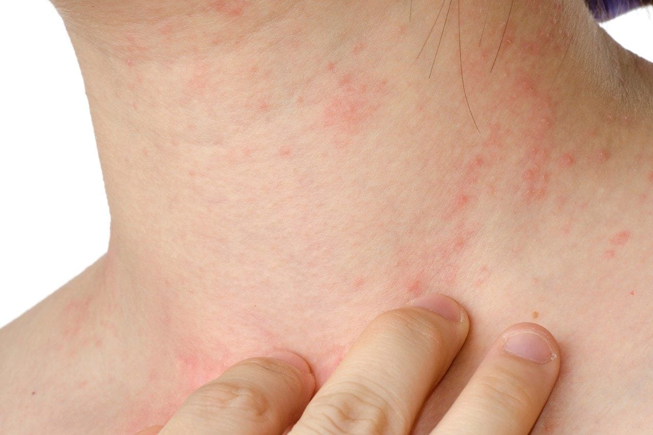 Clobetasol and Related Compound | Waters