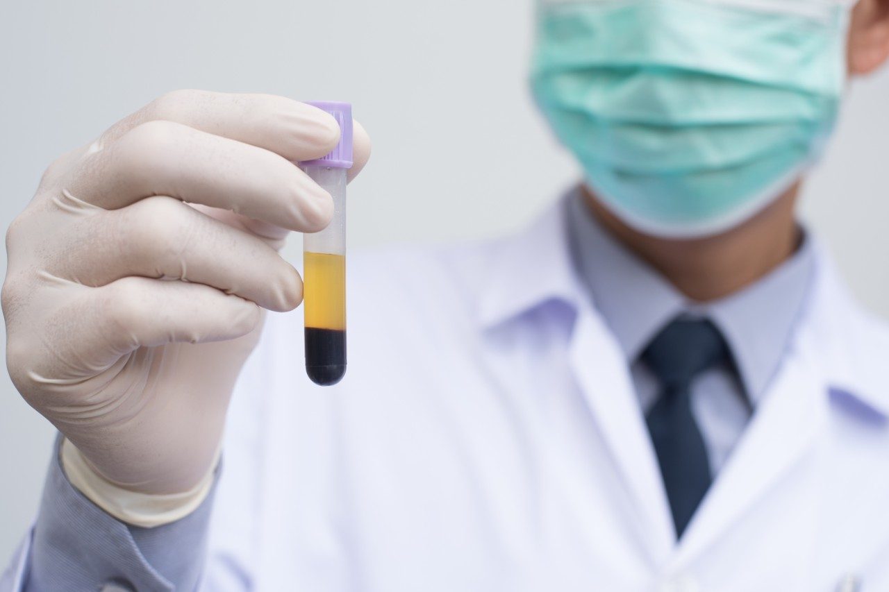 Improving a High Sensitivity Assay for the Quantification of ...