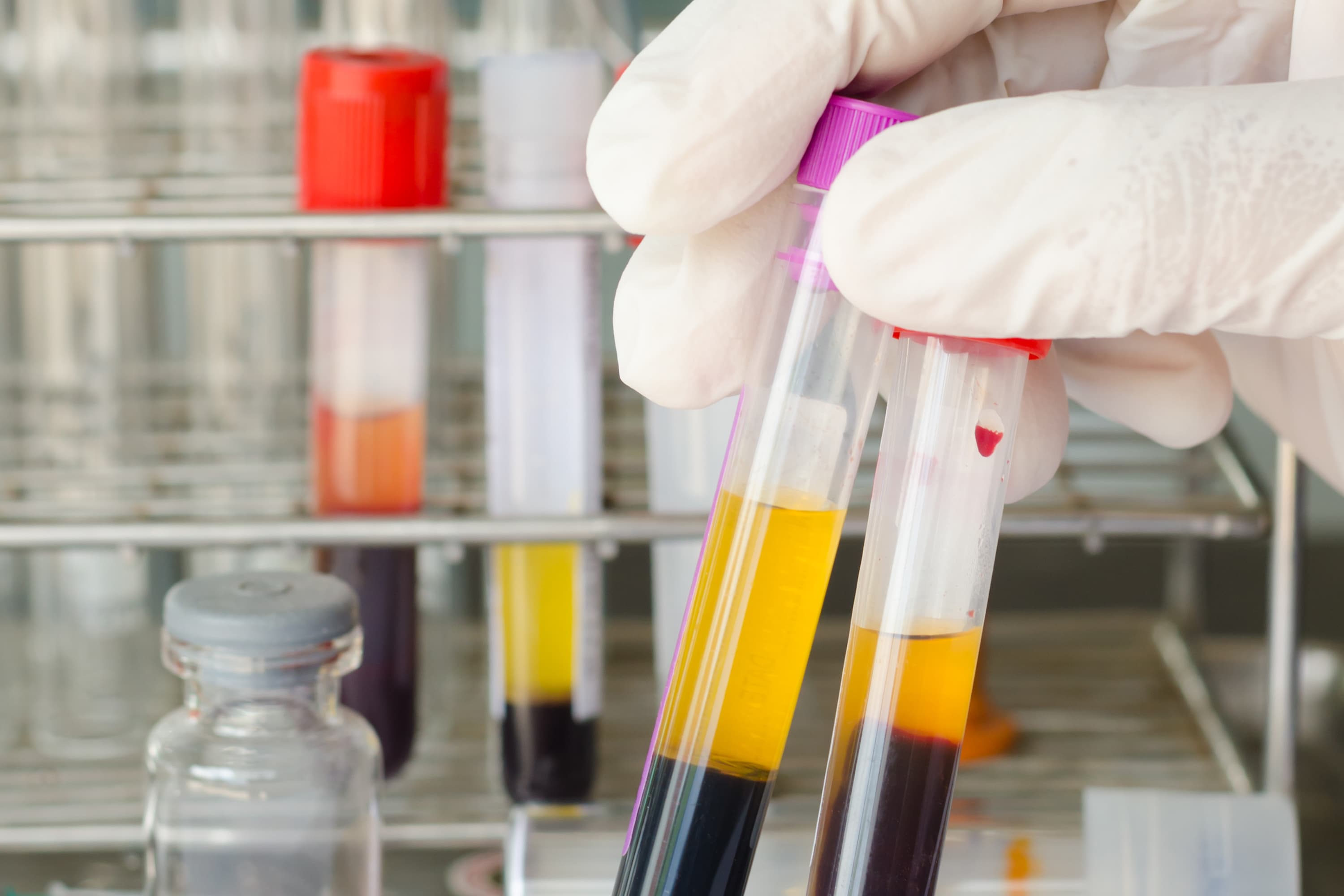 Amyloid Beta Peptides Quantification by SPE-LC-MS/MS with Automated ...