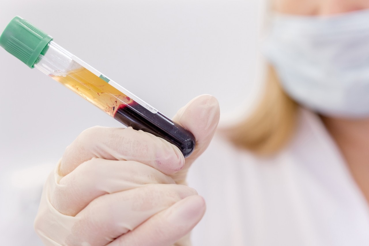 The Analysis of Total Homocysteine in Plasma Using a Quattro Micro ...